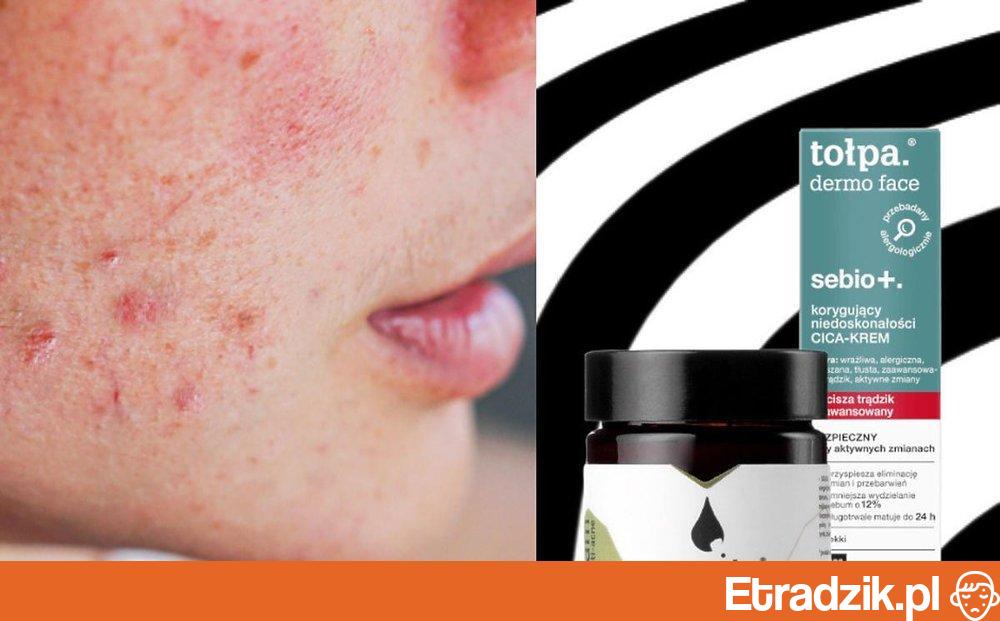 Leki na trądzik podskórny - które wybrać